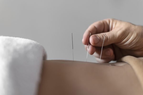 How Does Acupuncture Work? Unlocking the Pathways to Healing - Li ...